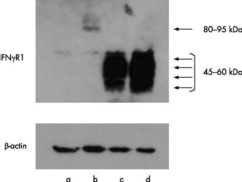 The Novel Ifngr1 Mutation 774del4 Produces A Truncated Form Of Interferon γ Receptor 1 And Has A