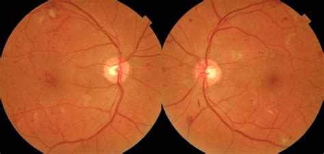 Sleep Apneas Connection To Retinal Vascular Disease