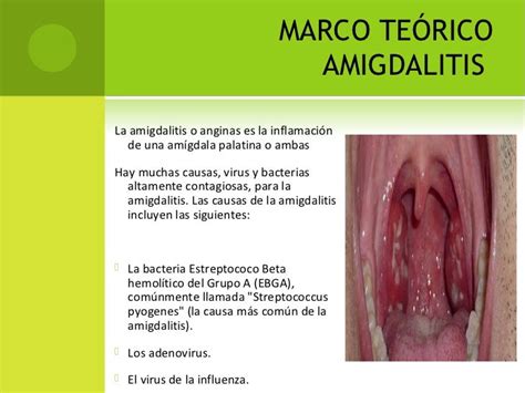Amigdalitis