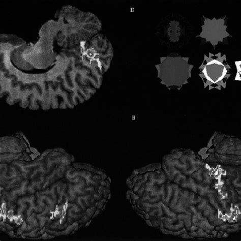 A B Increased Activity During Encoding Compared With Retrieval A Download Scientific