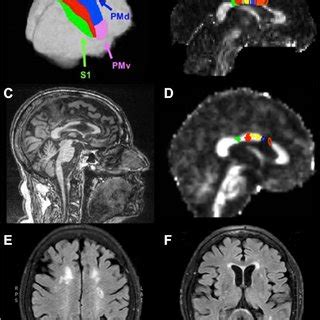 Diffusion Tensor Imaging Interhemispheric Fiber Tracts Connecting Download Scientific Diagram