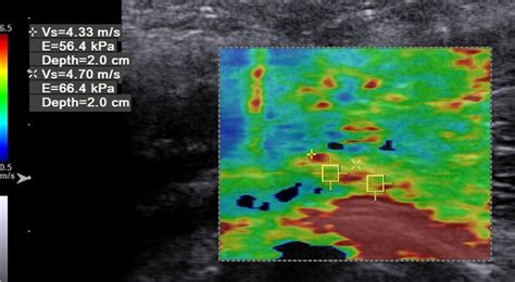Left Labrum Shear Wave Elastography Values Of Two Measurements E