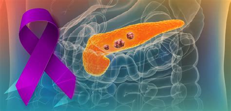 Nccn Expands Genetic Risk Assessment Guidelines To Include Additional Tumor Types Cancernetwork