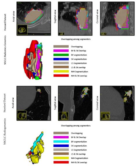 3d Tumor Volume 3d Tumor Volumes For Four Segmentation Cases And Two Download Scientific