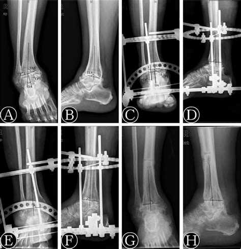 Example Of A 51‐year‐old Female Patient A The Preoperative Tas Cpt Download Scientific