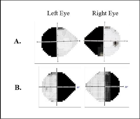 Figure 1 From Dissociations Between Perception And Awareness In Hemianopia Semantic Scholar