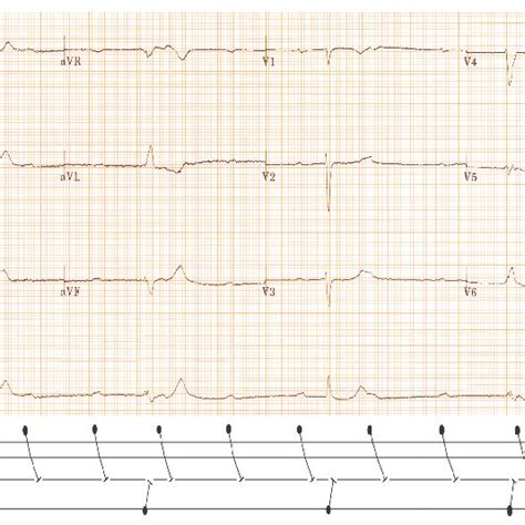 algorithms depicting the way to pacemaker mode selection with the