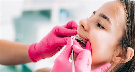 How To Know You Might Need Braces Health Facilities