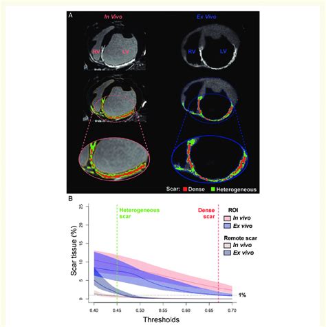 Myocardial And Scar Segmentation Process A Sample Case Of Myocardial