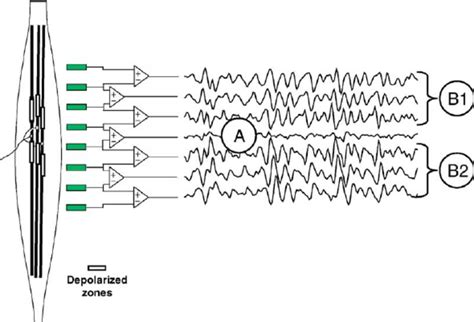 The Figure Shows An Example Of Emg Signal Recorded With Linear Download Scientific Diagram