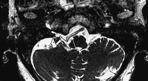 Mr Imaging Of The Cisternal Segment Of The Posterior Group Of Cranial
