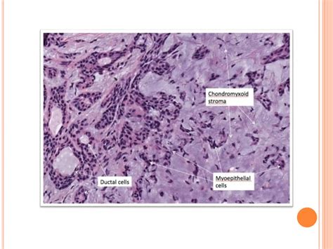Pleomorphic Adenoma Presentaion Ssspptx