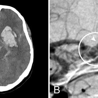 Preoperative Images A Computed Tomography Scan Demonstrating Diffuse Download Scientific