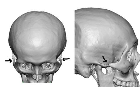Posterior Zygomatic Arch Osteotomies 3d Ct Scan Result Dr Barry Eppley