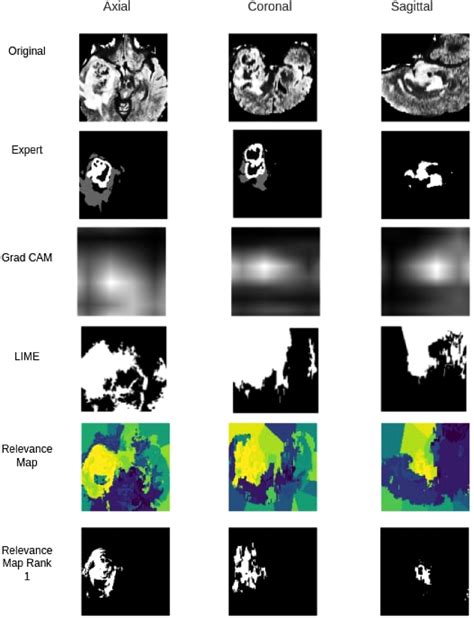 Frontiers Relevance Maps A Weakly Supervised Segmentation Method For 3d Brain Tumours In Mris