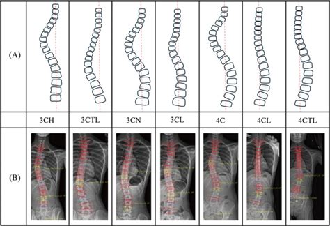 2d And 3d Classification Systems For Adolescent Idiopathic Scoliosis Clinical Implications And