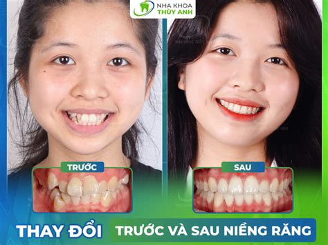 Khuôn Mặt Trước Và Sau Khi Niềng Răng Sự Thay đổi Tích Cực Và Cân đối
