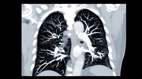 Ctpa Or Cta Pulmonary Artery For Diagnostic Pulmonary Embolism And X28 Peand X29 Lung Cancer And
