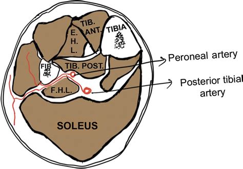 Posterior Tibial Artery Coursing Between The Fibula And FHL Download Scientific Diagram