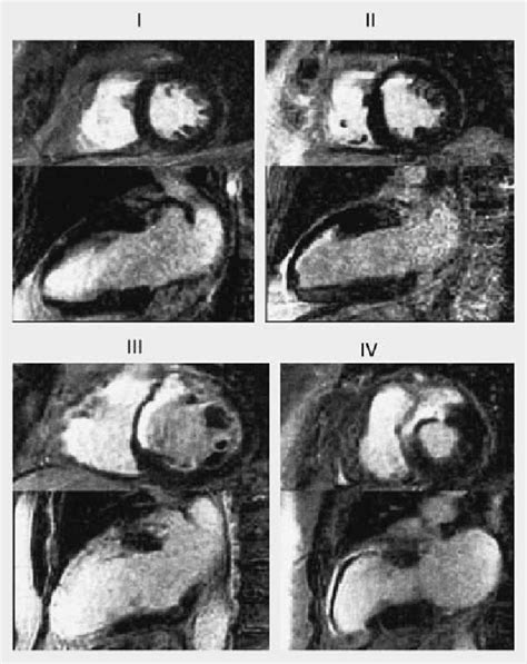 Typical Examples Of The Different Tissue Reperfusion Scores Detected By