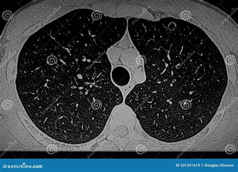 Ct Scan Of Small Cavity Of Tuberculosis In The Left Upper Lobe Stock