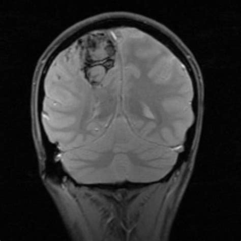 Pdf Brain Cavernomas Associated With En Coup De Sabre Linear Scleroderma Two Case Reports