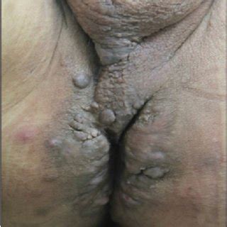 A Deep Seated Inflamed And Painful Nodules With Odorous Discharge Download Scientific