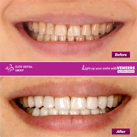 Complete Dental Veneer Procedure At Elite Dental Elitedental English