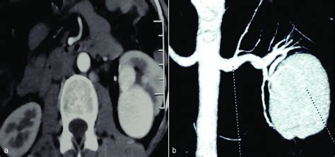 A Axial Contrast Computed Tomography Of Abdomen And Three Dimensional Download Scientific