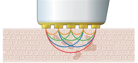 Melanoma Detection Device Archives Dallas Innovates