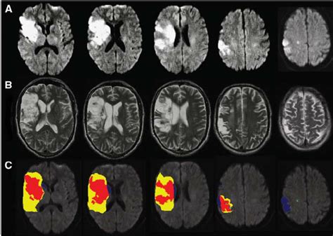 A Patient With Apparent Diffusion Lesion Reversal Due To Infarct Download Scientific Diagram