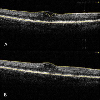 Macular OCT Scan Of A Subject With Age Related Macular Degeneration Download Scientific