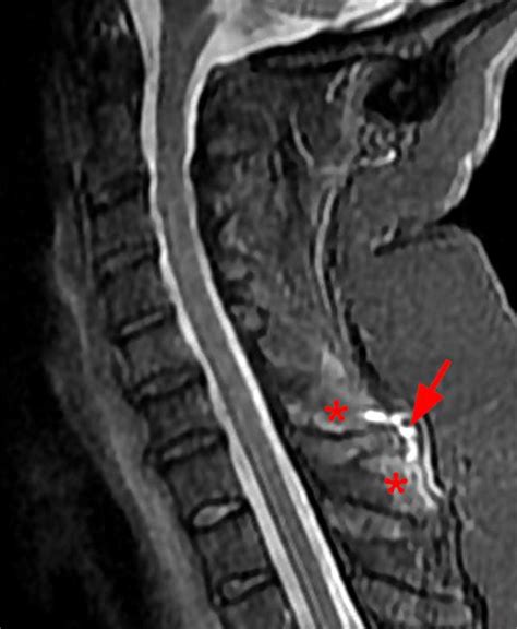 Cervical Interspinous Bursitis Radsource