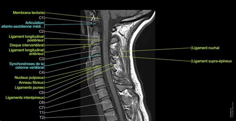 rachis cervical IRM : anatomie normale | e-Anatomy