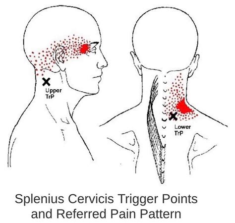 Splenius Capitis And Cervicis Muscles ⠀ Anatomy Function And Pathology ⠀ The Splenius Capitis