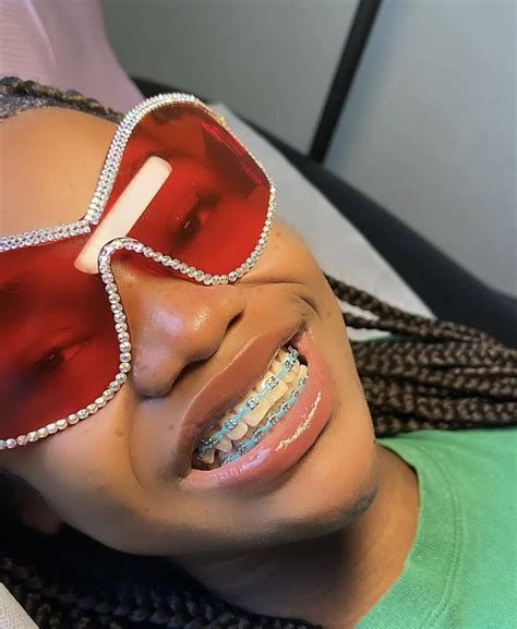 Shop Fake Braces — 14kbraces