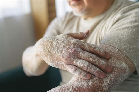 Closeup Of The Peeling Skin Of A Man On His Hands With Eczema Psoriasis