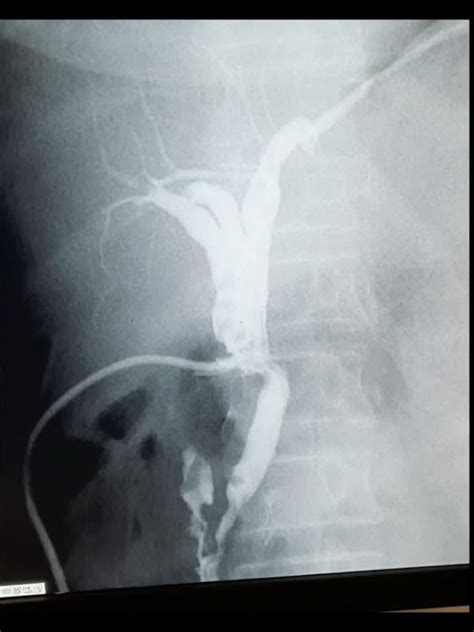 T Tube Cholangiogram Cbd Stricture Choledocholithiasis Youtube