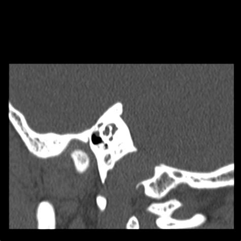 Normal Temporal Bone Ct With Annotated Images Radiopaedia 84293 99584 Lt Poschl Nc Commons