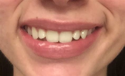How To Fix Uneven Lips When Smiling Lipstutorial Org