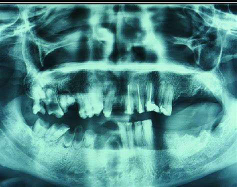 Preoperative Radiographic View Download Scientific Diagram