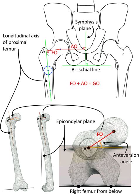Definitions Of Ct Measurements In The Frontal And Transversal Planes