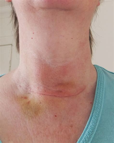 Partial Thyroidectomy Before And After Photos Partial Thyroidectomy Before And After Photos