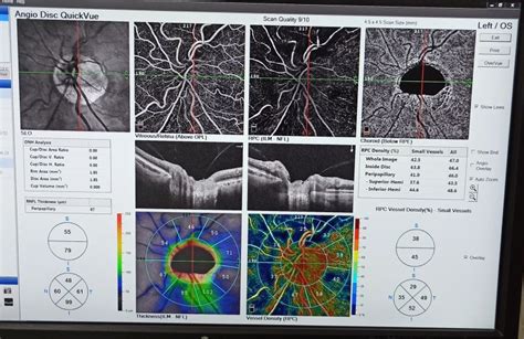 Mohammad Daraei On Linkedin Oct Octa Optovue Peripapillary