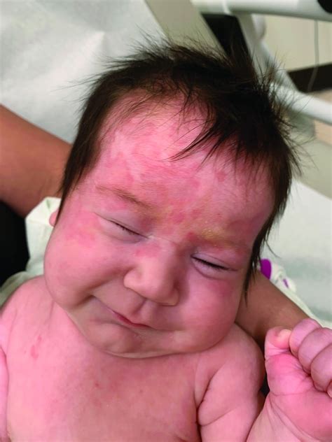 Seborrheic Dermatitis Scalp Infant