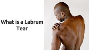 What Is A Labrum Tear Where Soul Meets Body Learn