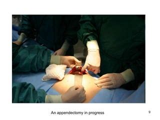 Appendicitis Pathophysiology And Its Management PPT