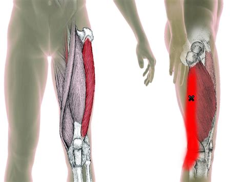 Vastus Lateralis Trigger Points Life After Pain