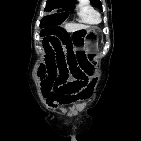 File Small Bowel Volvulus Causing Small Bowel Obstruction Mimicking Intussusception