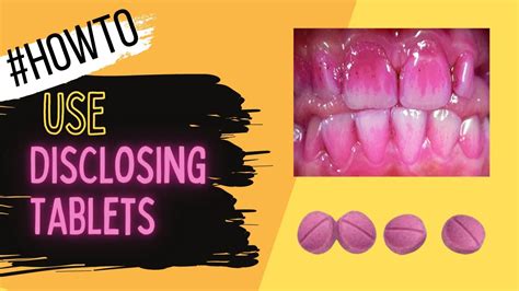 How To Use Disclosing Tablets Plaque Detection Tips For Better Oral Health Youtube